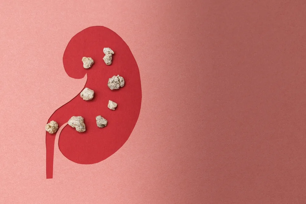7 Essential Tips to Conquer Kidney Stones: Causes, Symptoms & Treatment ...